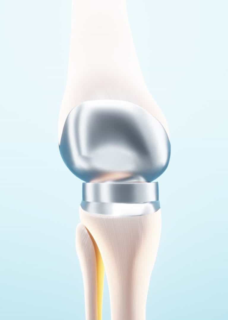 Prótesis de Rodilla - Centro Médico Pedregal