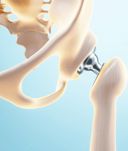 Prótesis de Cadera - Centro Médico Pedregal